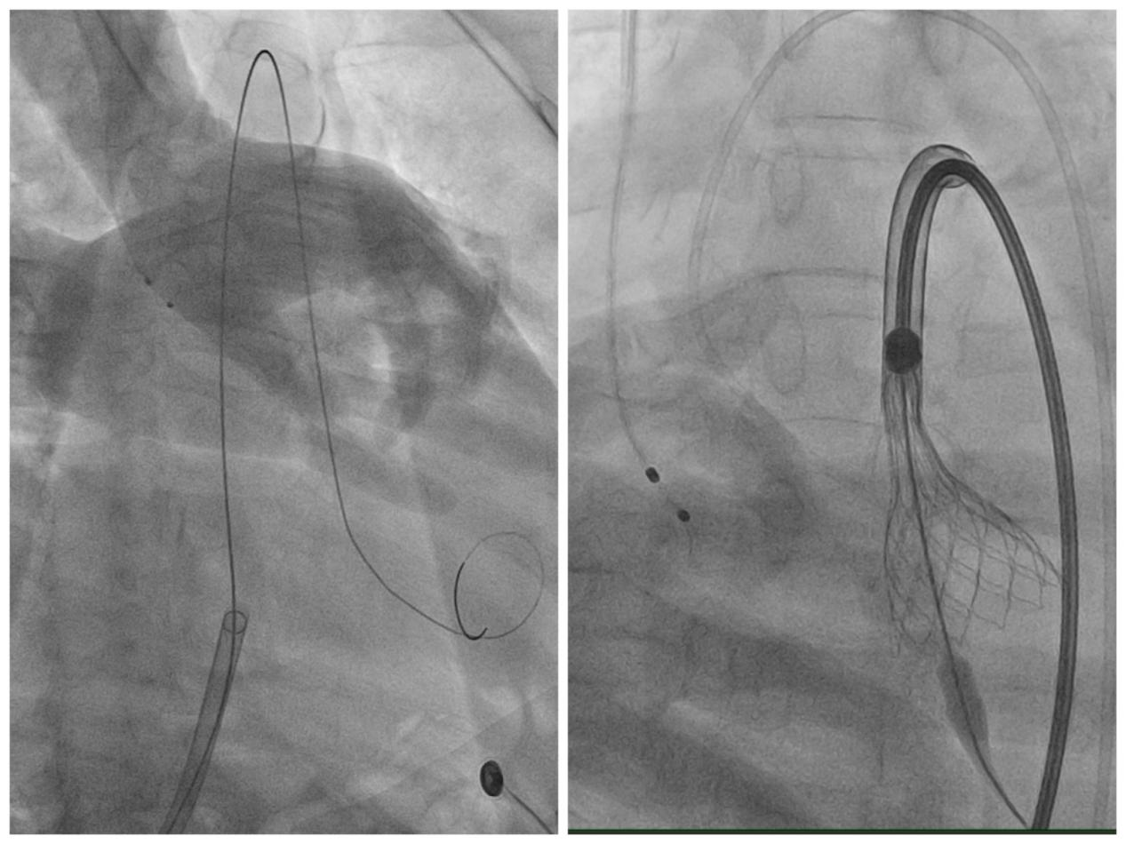 微创换“心门”丨高危TAVR术中除颤19次！团队配合终使患者化险为夷-广东省人民医院赣州医院（赣州市立医院）