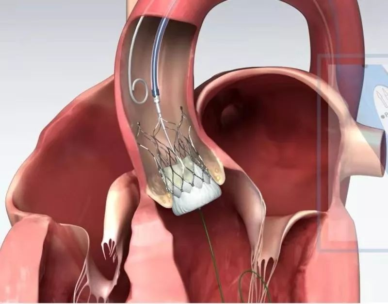 微创换“心门”丨高危TAVR术中除颤19次！团队配合终使患者化险为夷-广东省人民医院赣州医院（赣州市立医院）