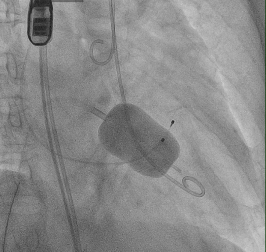 赣南首例！广东省人民医院赣州医院心内科团队成功完成一例一站式PBMV+TAVR冠脉高风险手术-广东省人民医院赣州医院（赣州市立医院）